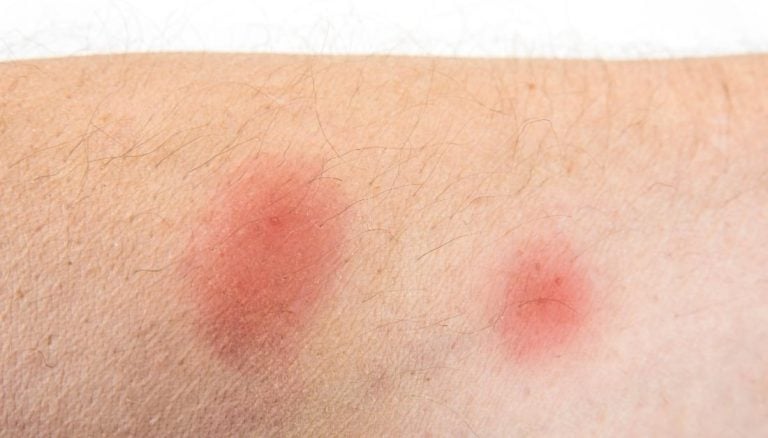 7 Bugs That Bite In Clusters [Picture Included]